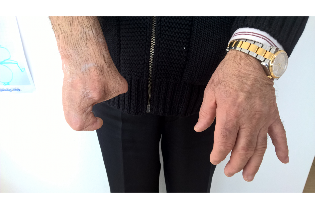 Protesi passive o estetiche in silicone - Mac Dowell Silicones