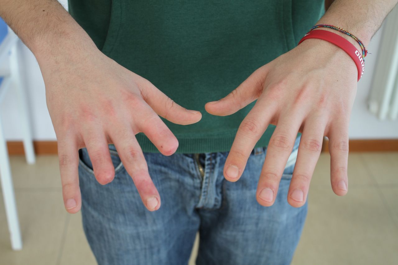 Protesi passive o estetiche in silicone - Mac Dowell Silicones