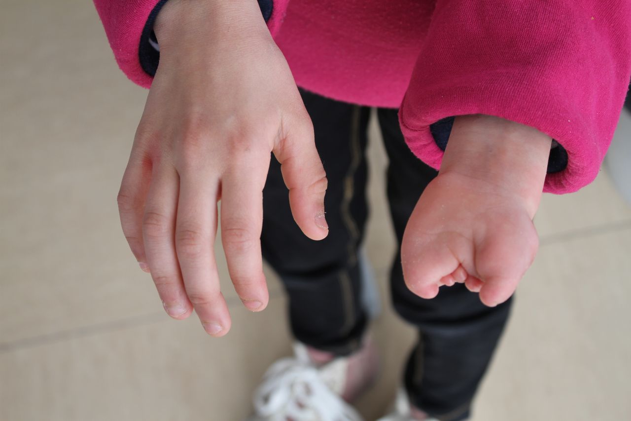 Protesi passive o estetiche in silicone - Mac Dowell Silicones