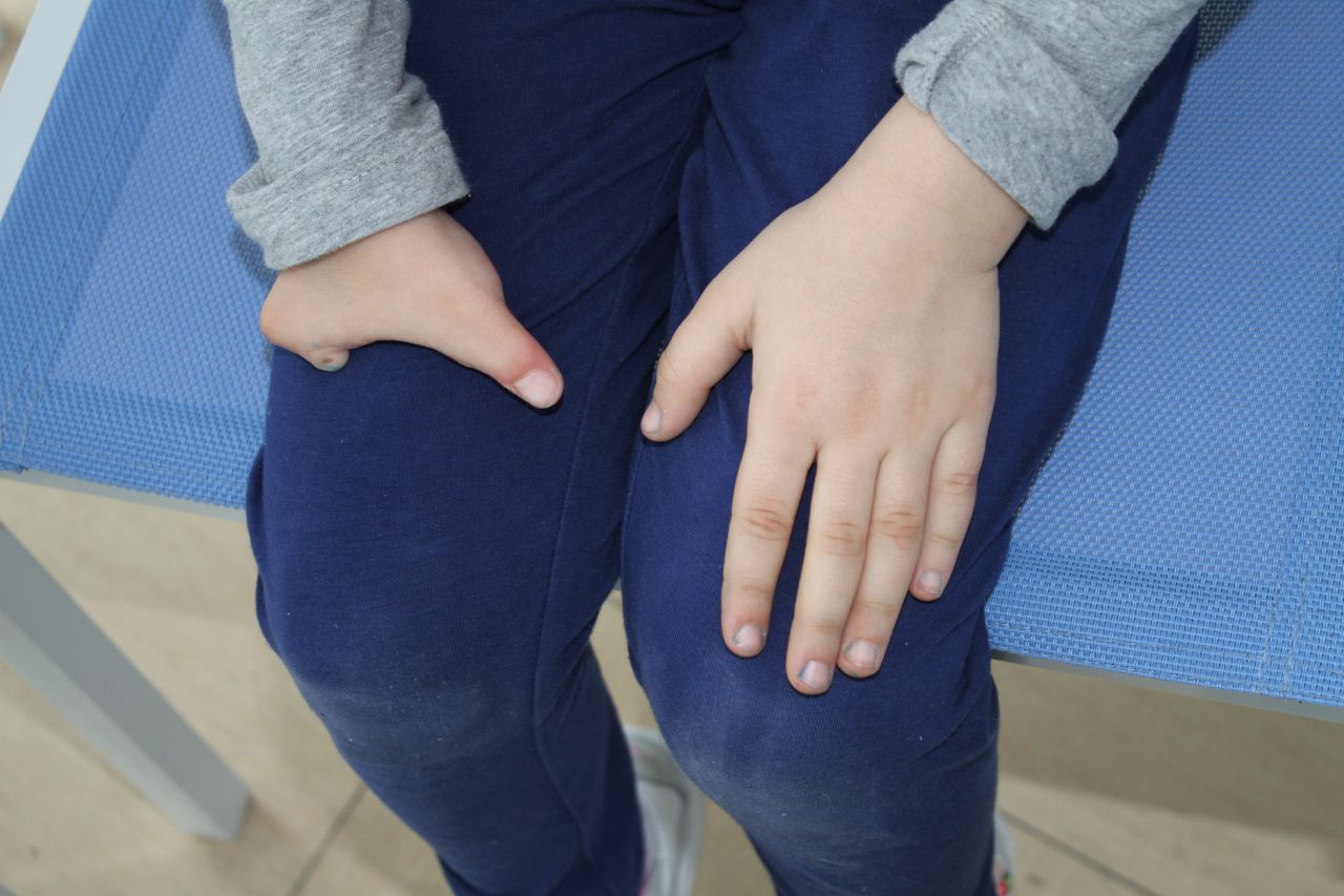 Protesi passive o estetiche in silicone - Mac Dowell Silicones