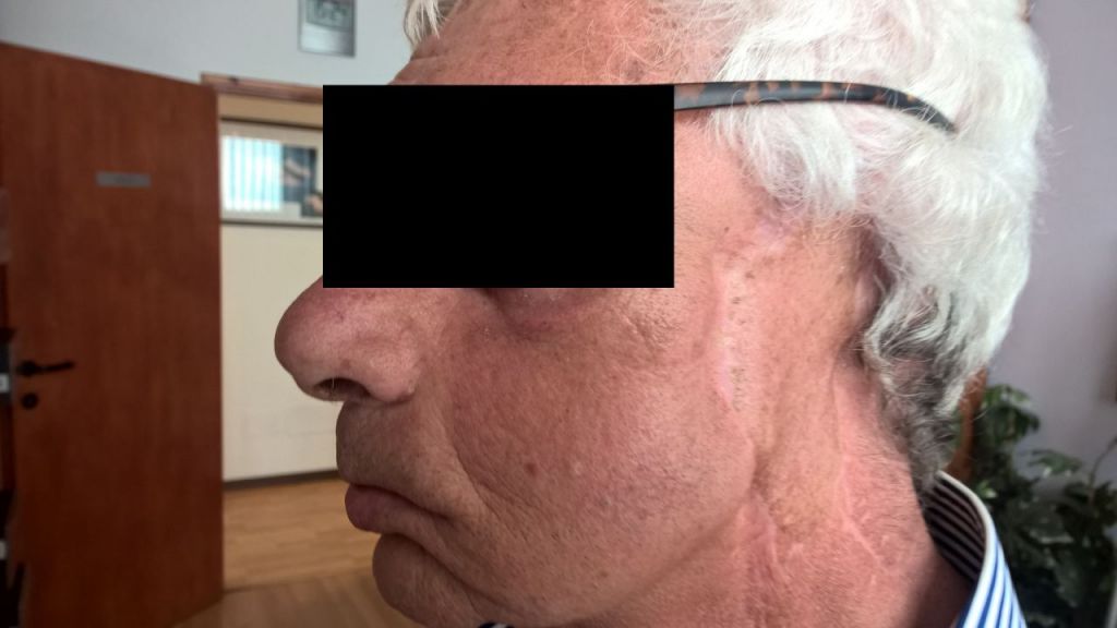 Epithesis or maxillofacial prosthesis - Mac Dowell Silicones