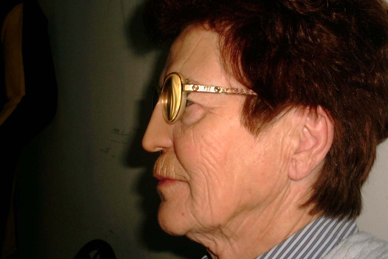 Epithesis or maxillofacial prosthesis - Mac Dowell Silicones